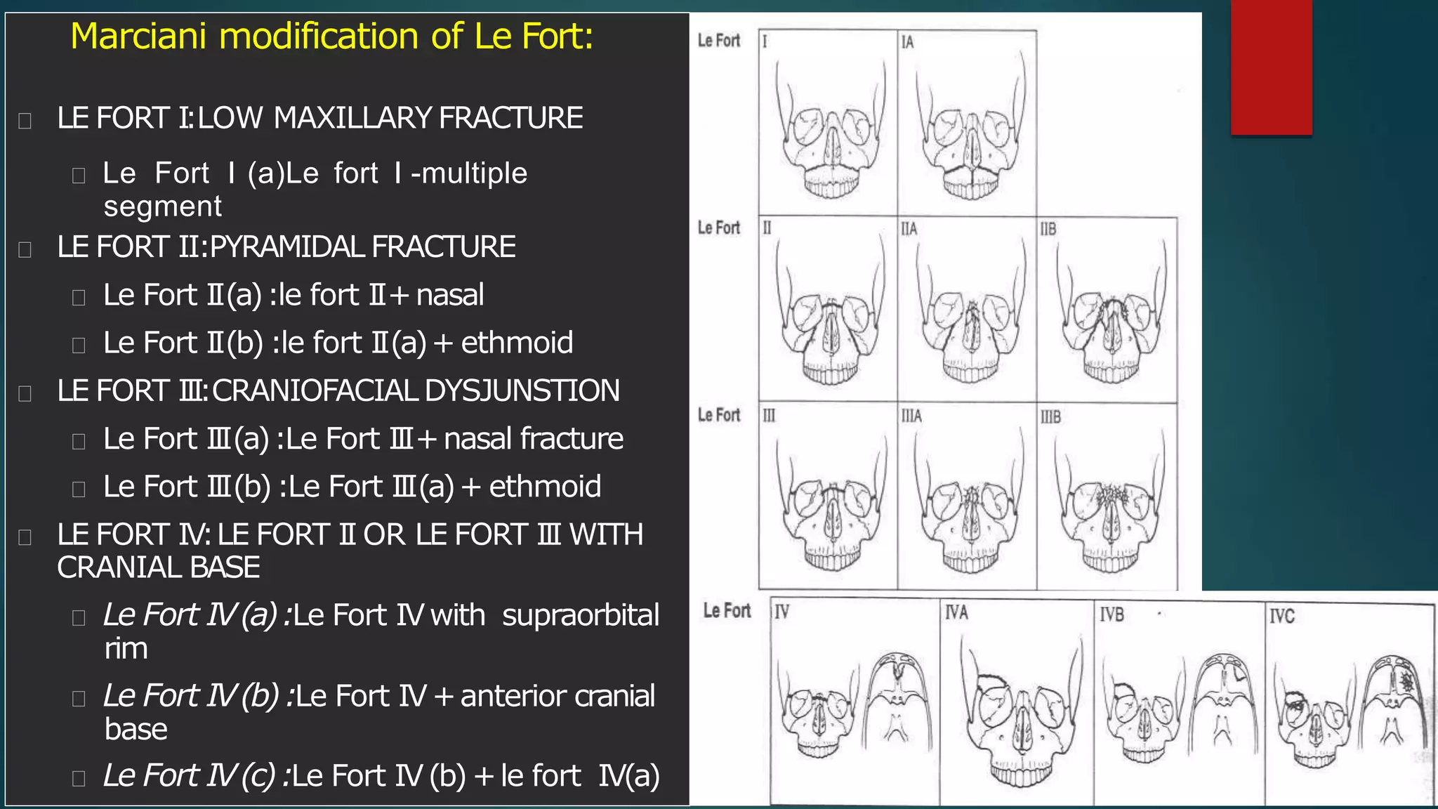 Midface fractures | PPTX