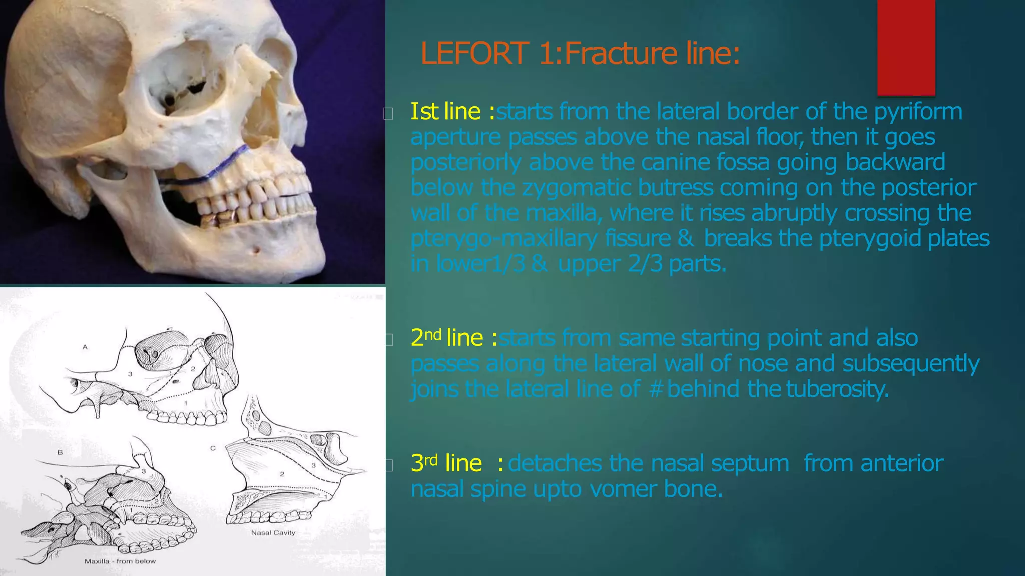 Midface fractures | PPTX