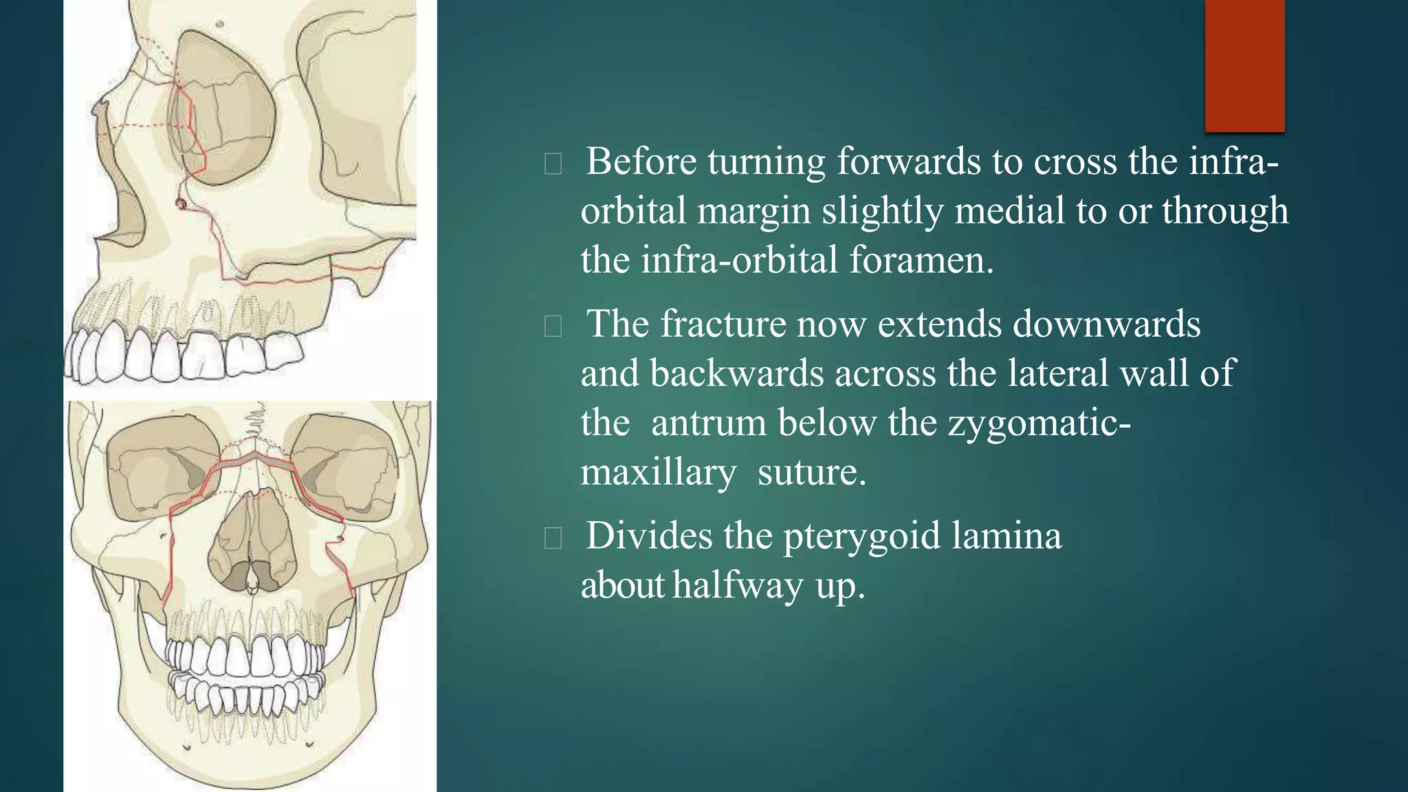 Midface fractures | PPTX