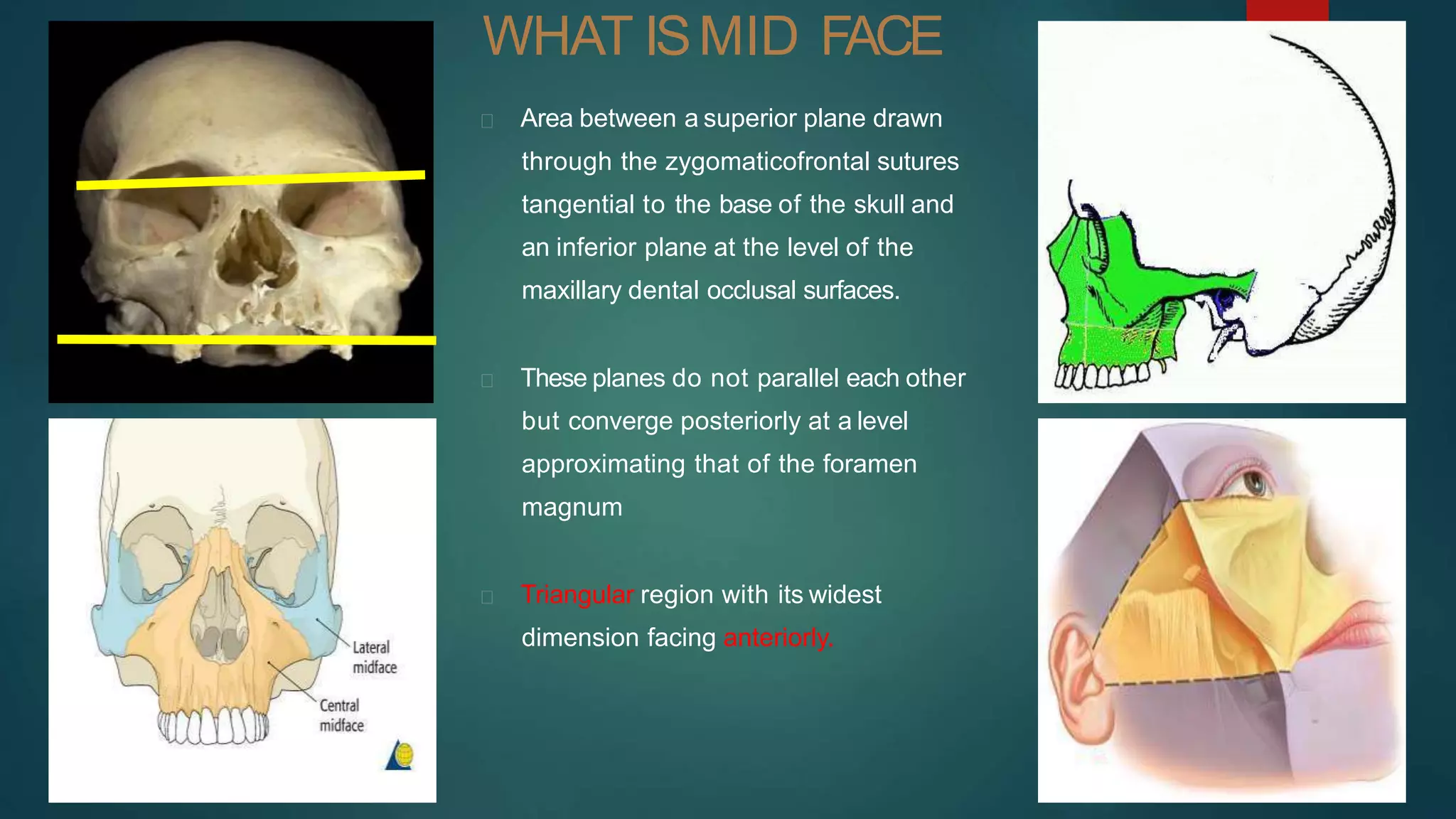 Midface fractures | PPTX
