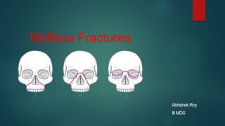 Midface fractures | PPT