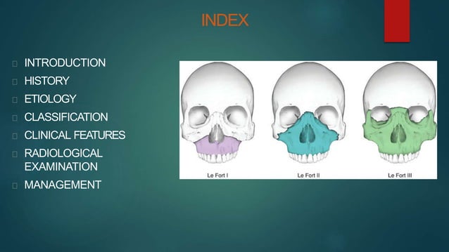 Midface fractures | PPTX