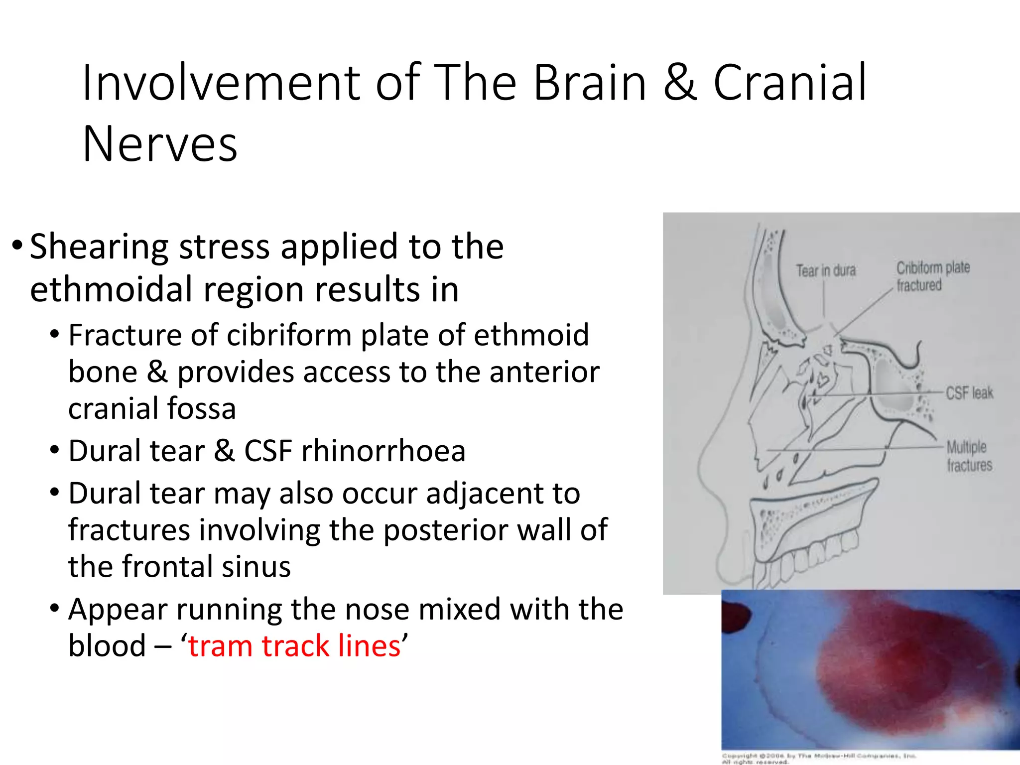 MID FACE FRACTURES.pptx