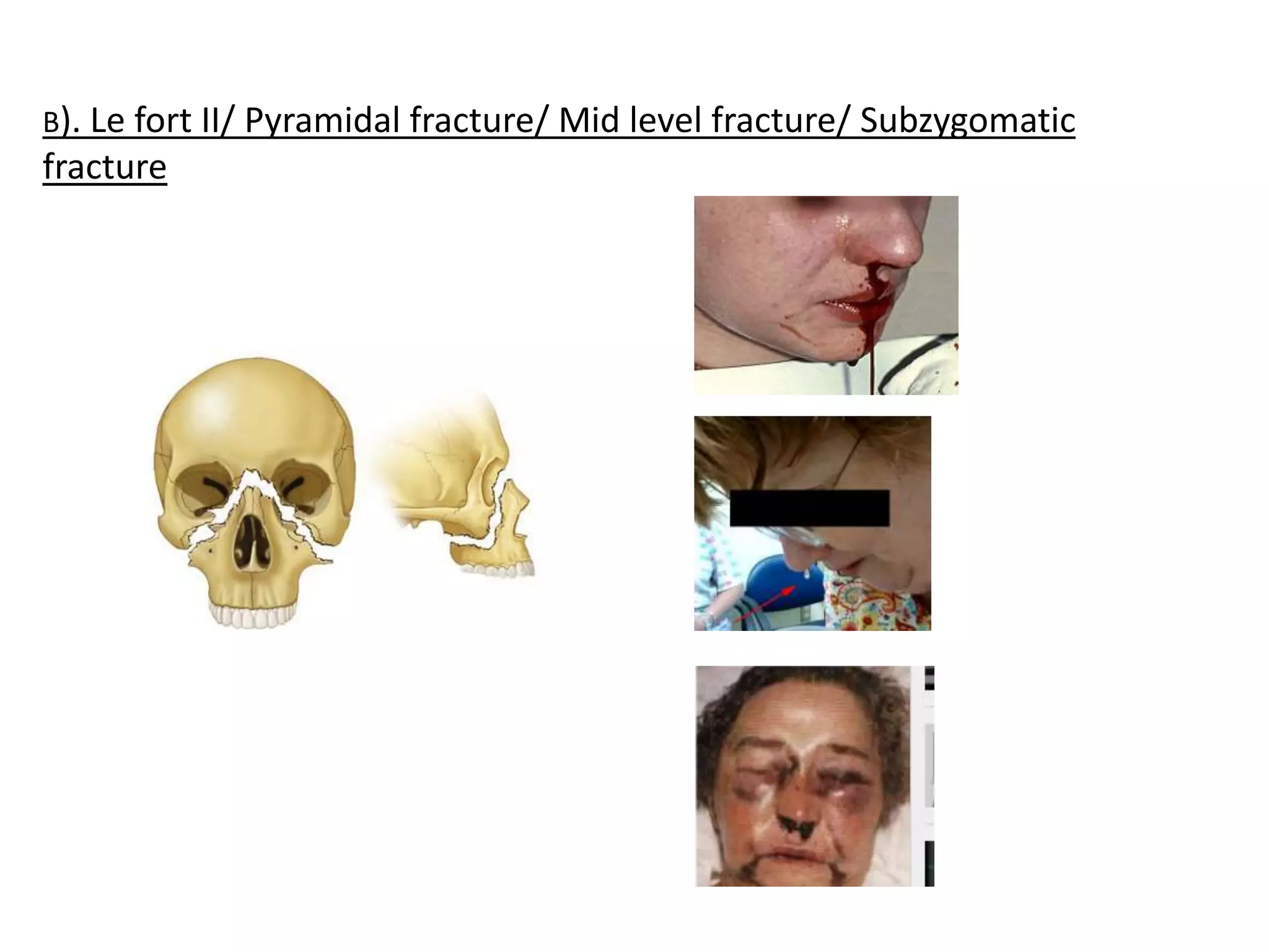 MID FACE FRACTURES.pptx