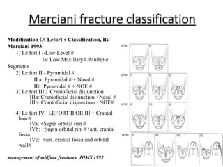 MID FACE FRACTURES.pptx