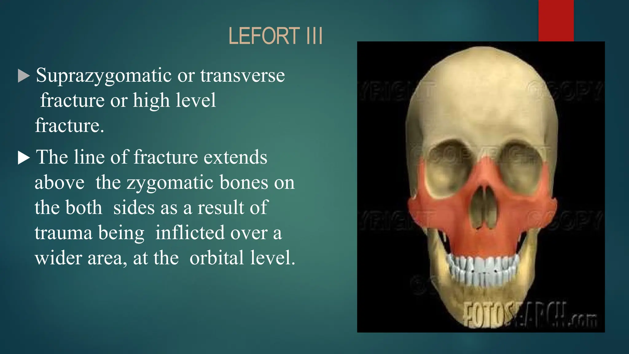 MIDDLE FACE FRACTURE. ETIOLOGY TREATMENT | PPT