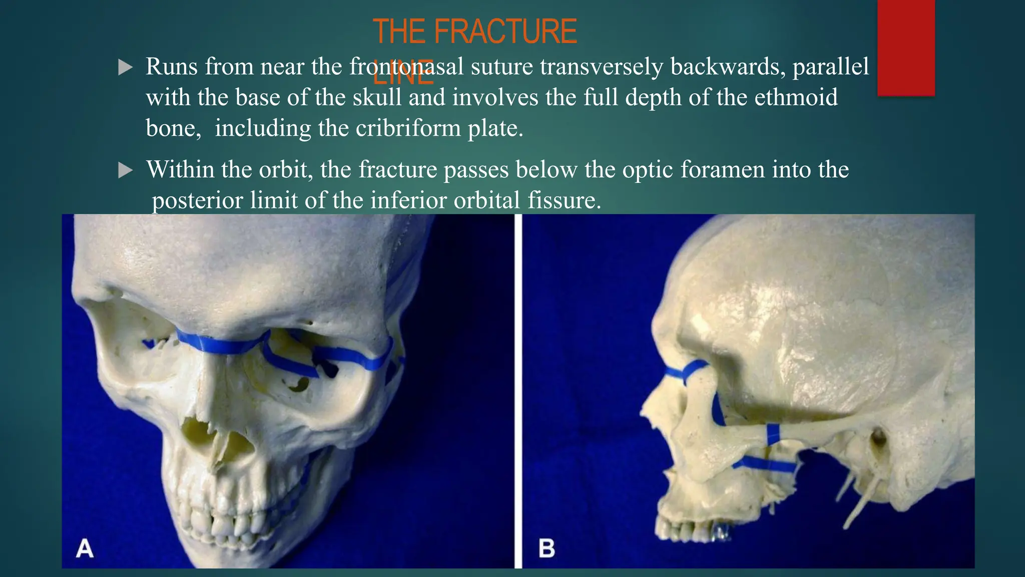 MIDDLE FACE FRACTURE. ETIOLOGY TREATMENT | PPT
