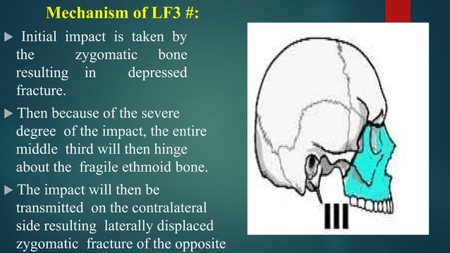 MIDDLE FACE FRACTURE. ETIOLOGY TREATMENT | PPT