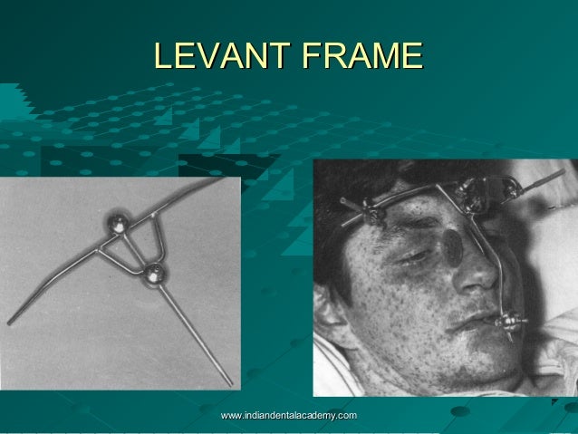 Mid face fractures#2 /certified fixed orthodontic courses by Indian