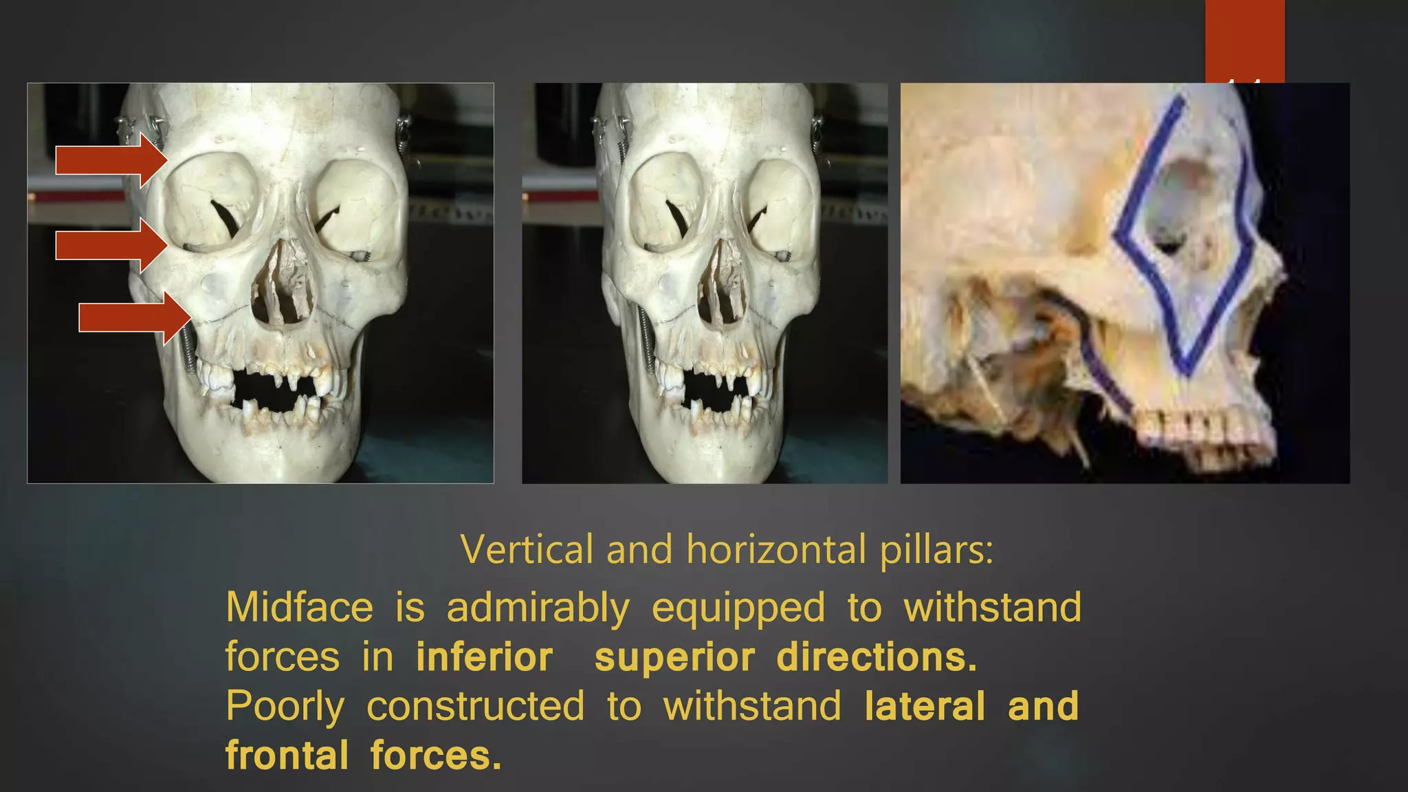 Midface fractures | PPTX