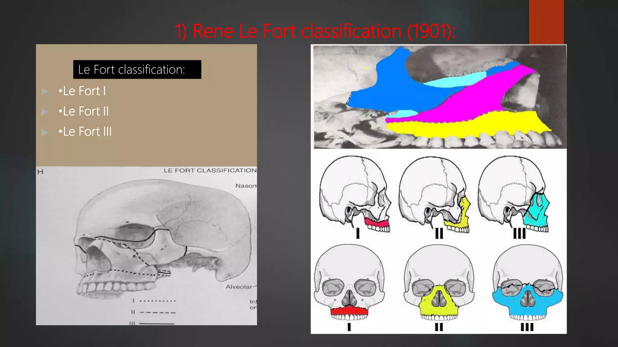 Midface fractures | PPTX