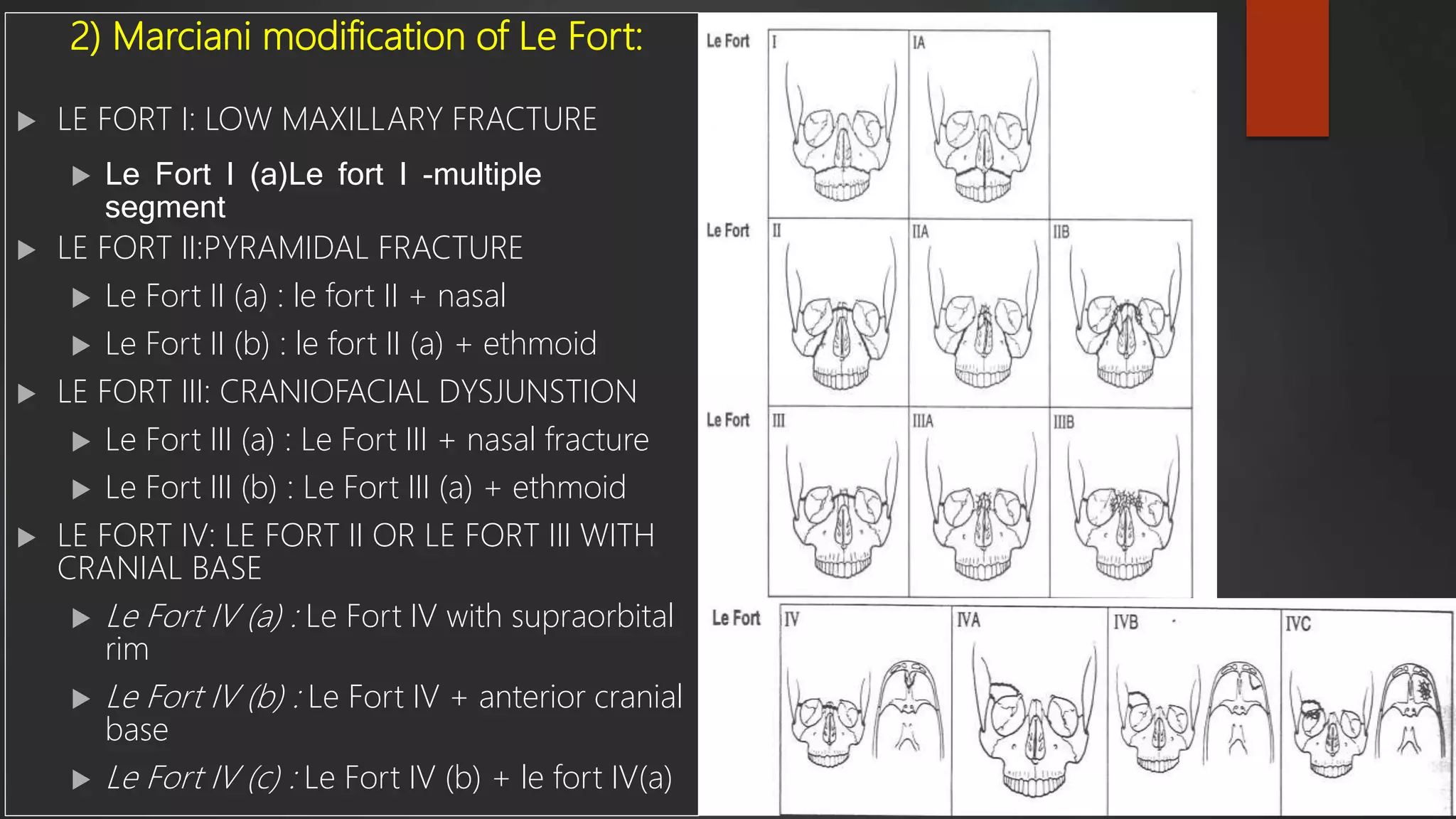 Midface fractures | PPTX