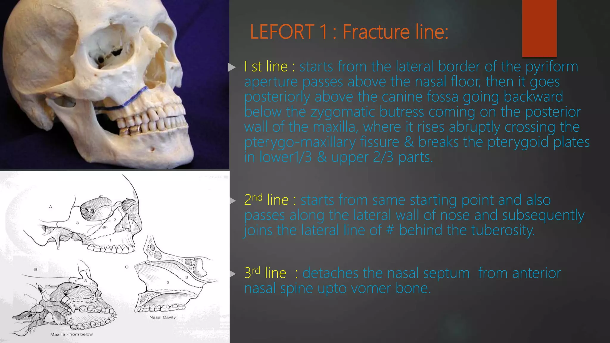 Midface fractures | PPTX