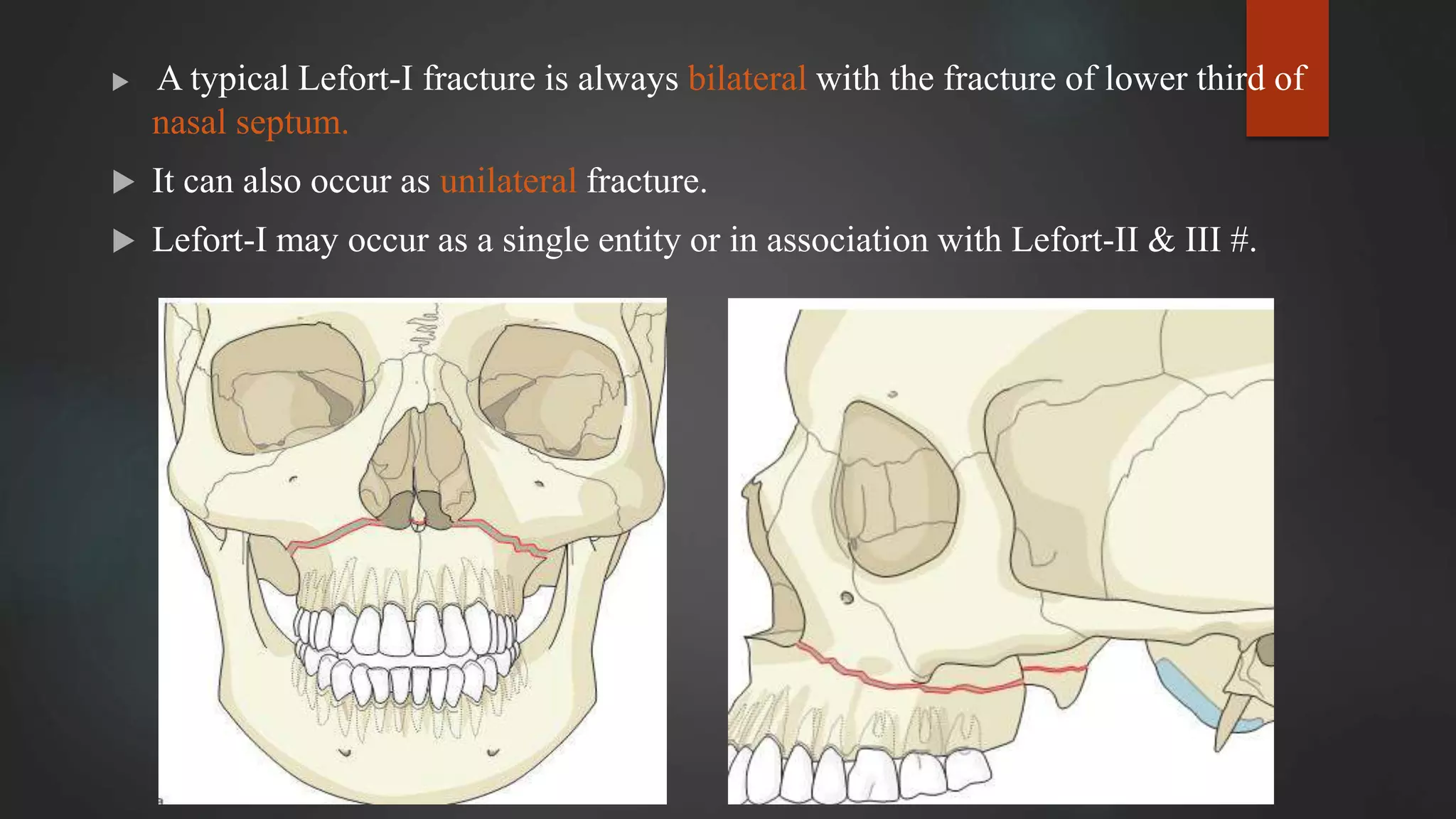 Midface fractures | PPTX