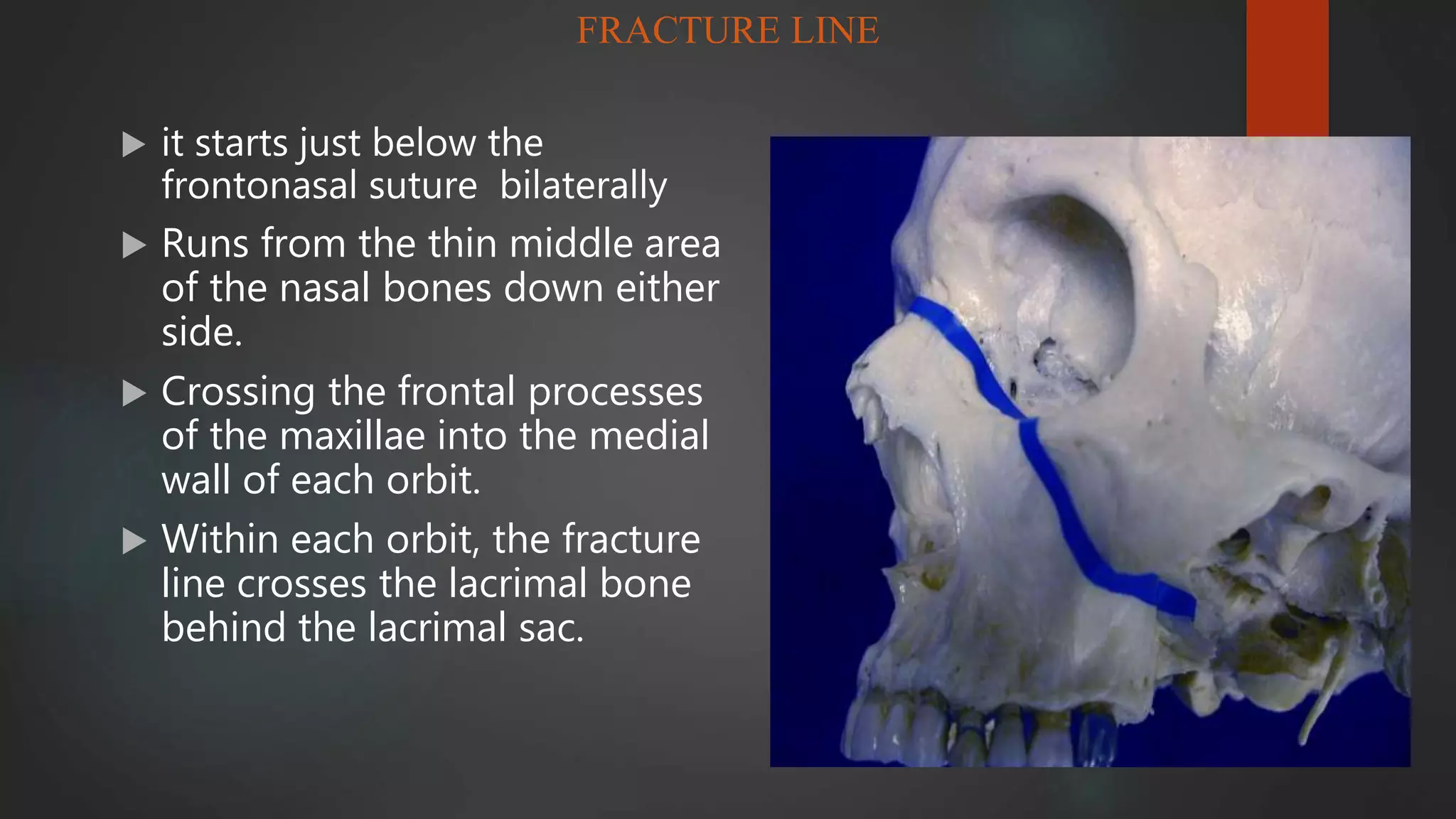 Midface fractures | PPTX