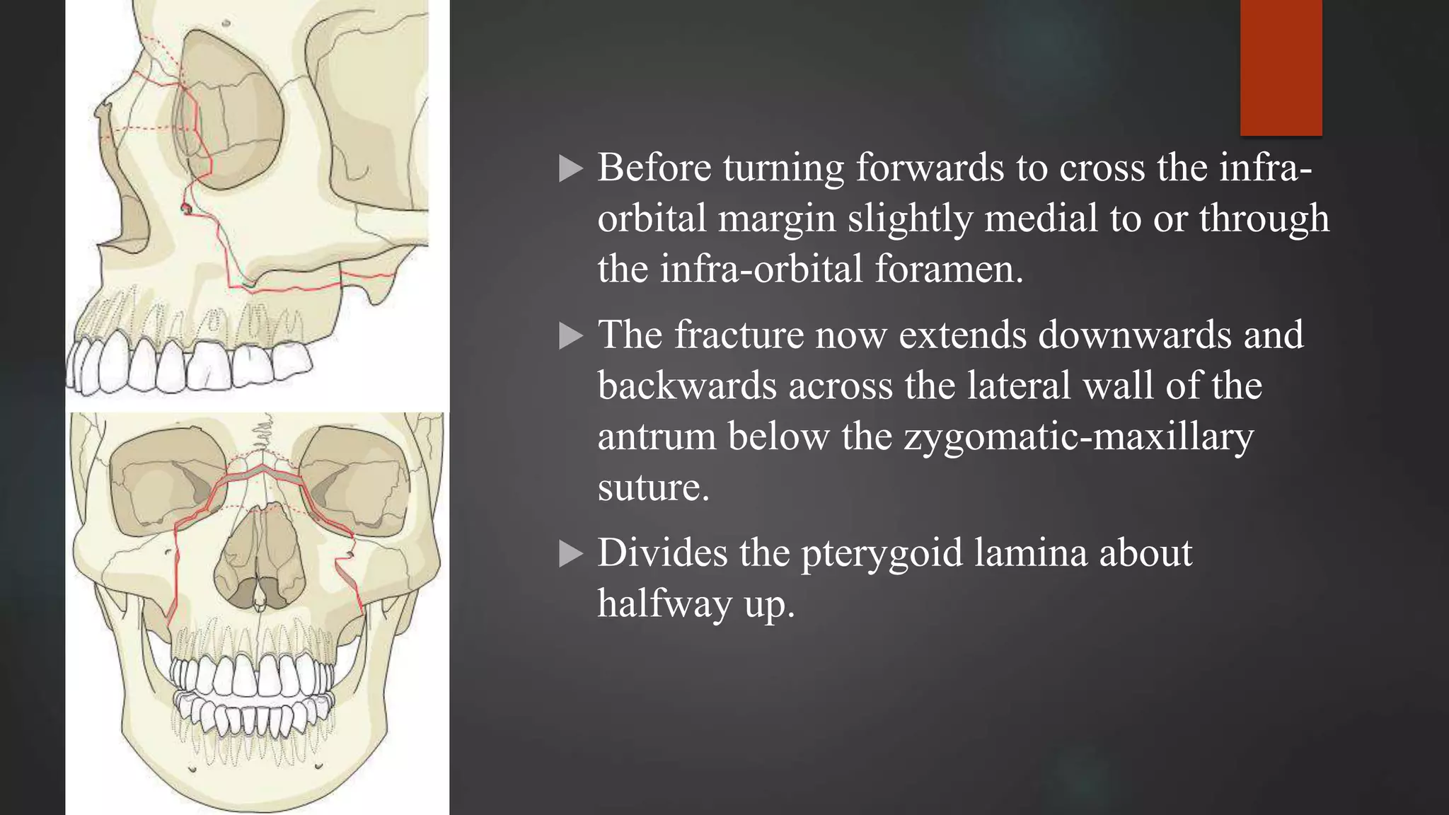 Midface fractures | PPTX