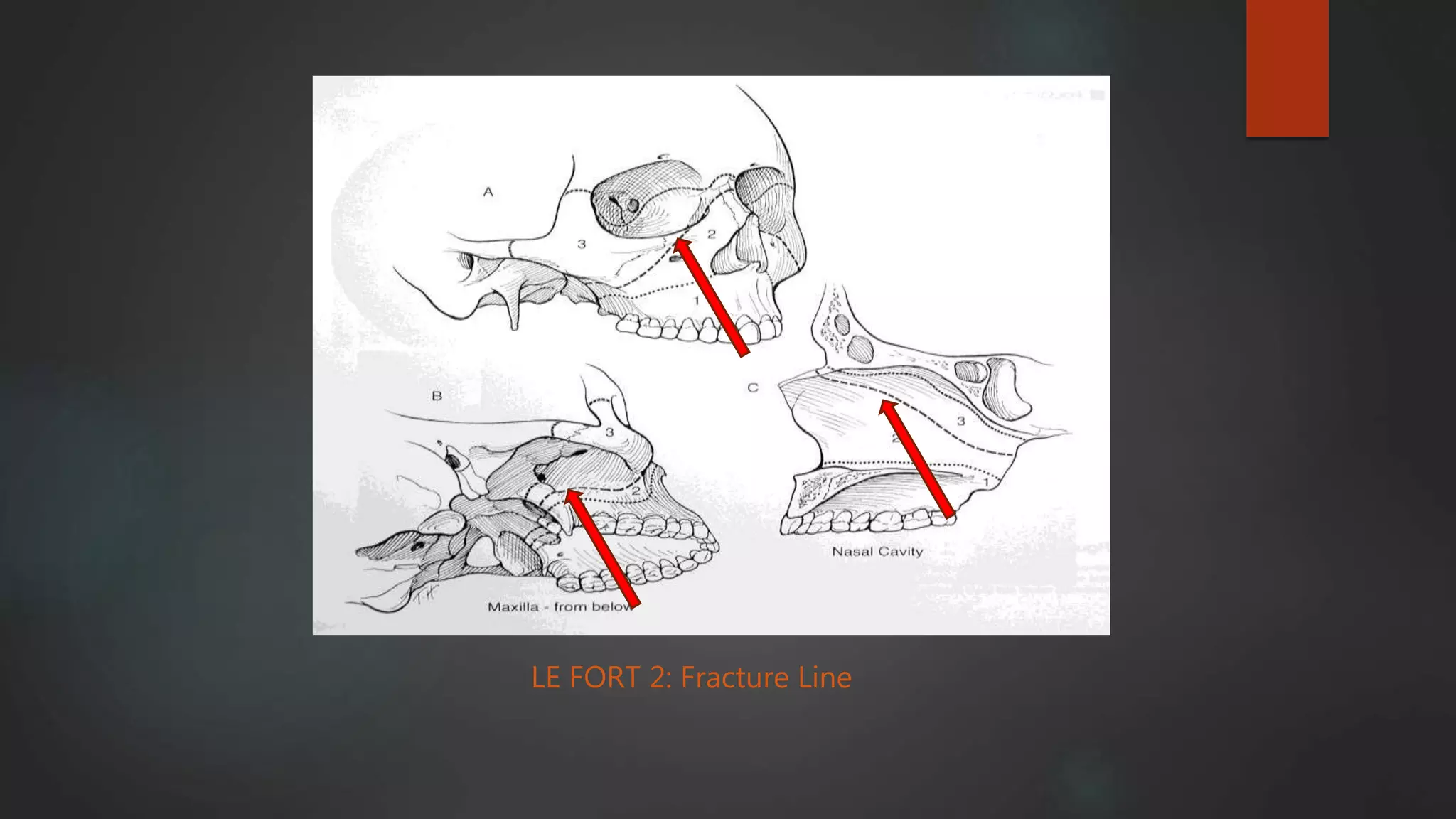 Midface fractures | PPTX