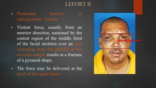 Midface fractures | PPTX
