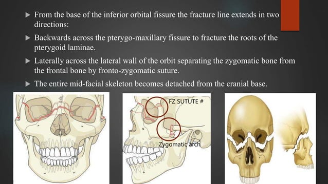 Midface fractures | PPTX