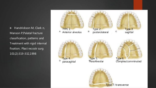 Midface fractures