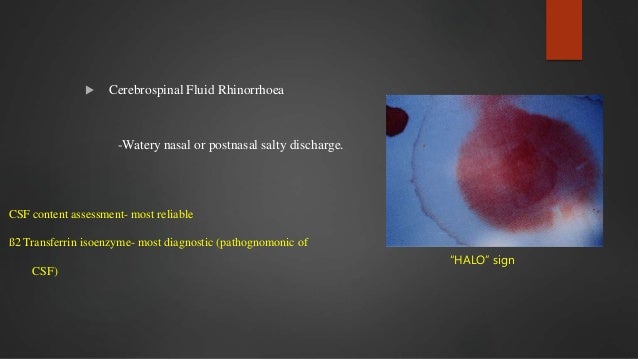 Midface Fractures
