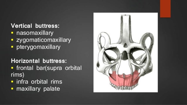 Midface fractures