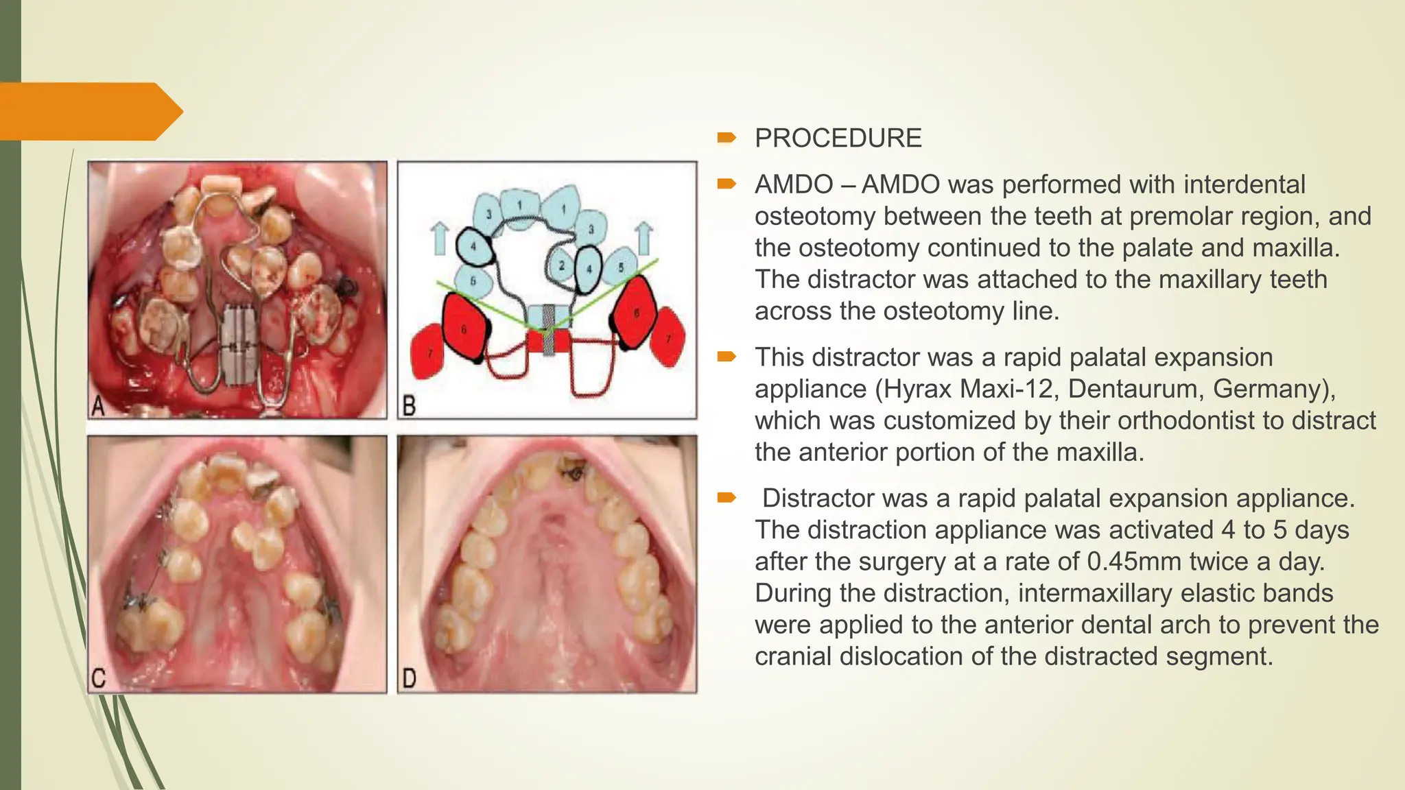 Midfacial Changes Through Anterior Maxillary Distraction Osteogenesis ...