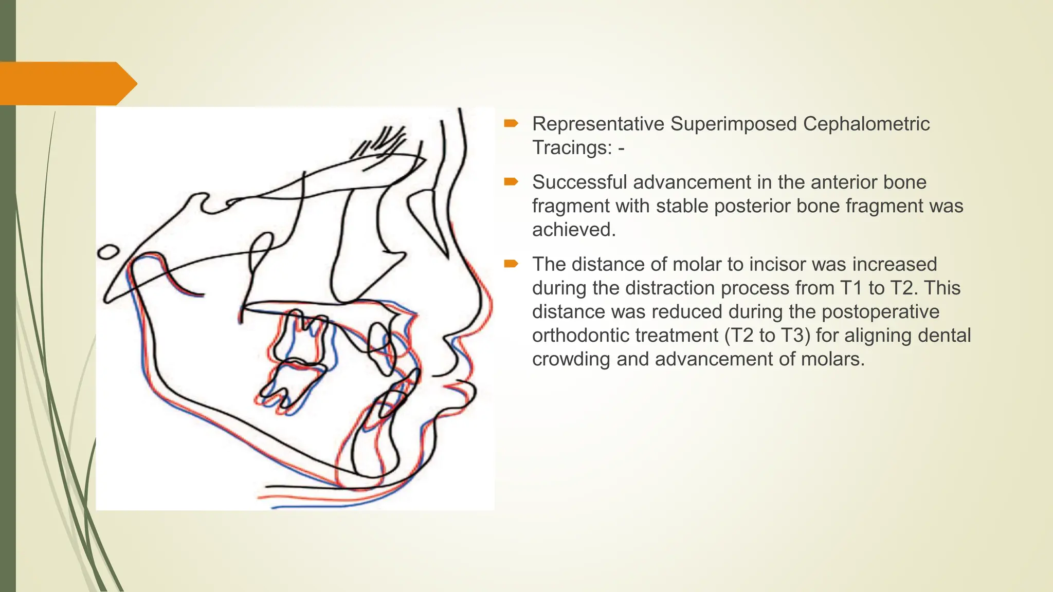Midfacial Changes Through Anterior Maxillary Distraction Osteogenesis ...