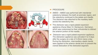 Midfacial Changes Through Anterior Maxillary Distraction Osteogenesis ...