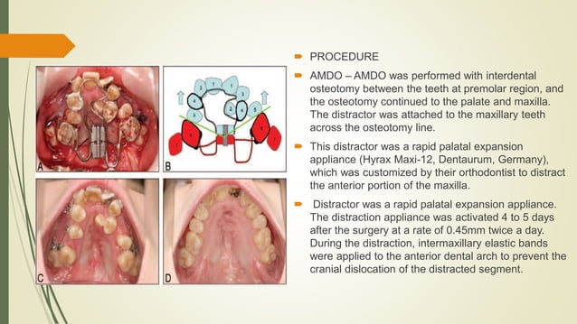 Midfacial Changes Through Anterior Maxillary Distraction Osteogenesis ...