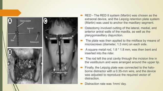 Midfacial Changes Through Anterior Maxillary Distraction Osteogenesis ...