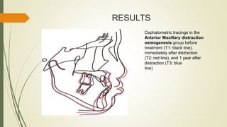 Midfacial Changes Through Anterior Maxillary Distraction Osteogenesis ...