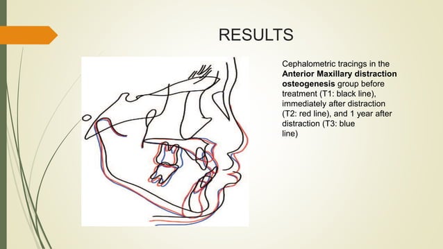 Midfacial Changes Through Anterior Maxillary Distraction Osteogenesis in.pptx