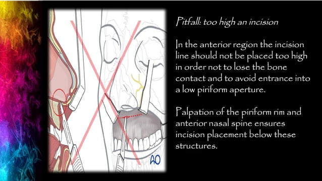 MIDFACIAL_DEGLOVING-SarayuShivani_U.pptx