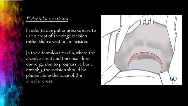 MIDFACIAL_DEGLOVING-SarayuShivani_U.pptx