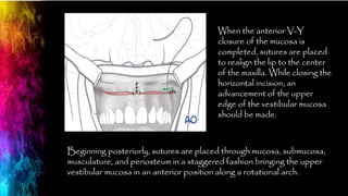 MIDFACIAL_DEGLOVING-SarayuShivani_U.pptx