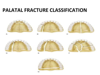 Midfacial fractures | PPTX