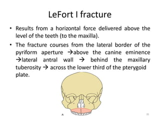 Midfacial fractures | PPTX