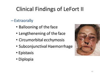 Midfacial fractures | PPTX