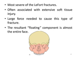 Midfacial fractures | PPTX