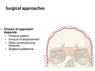 Midfacial fractures | PPTX