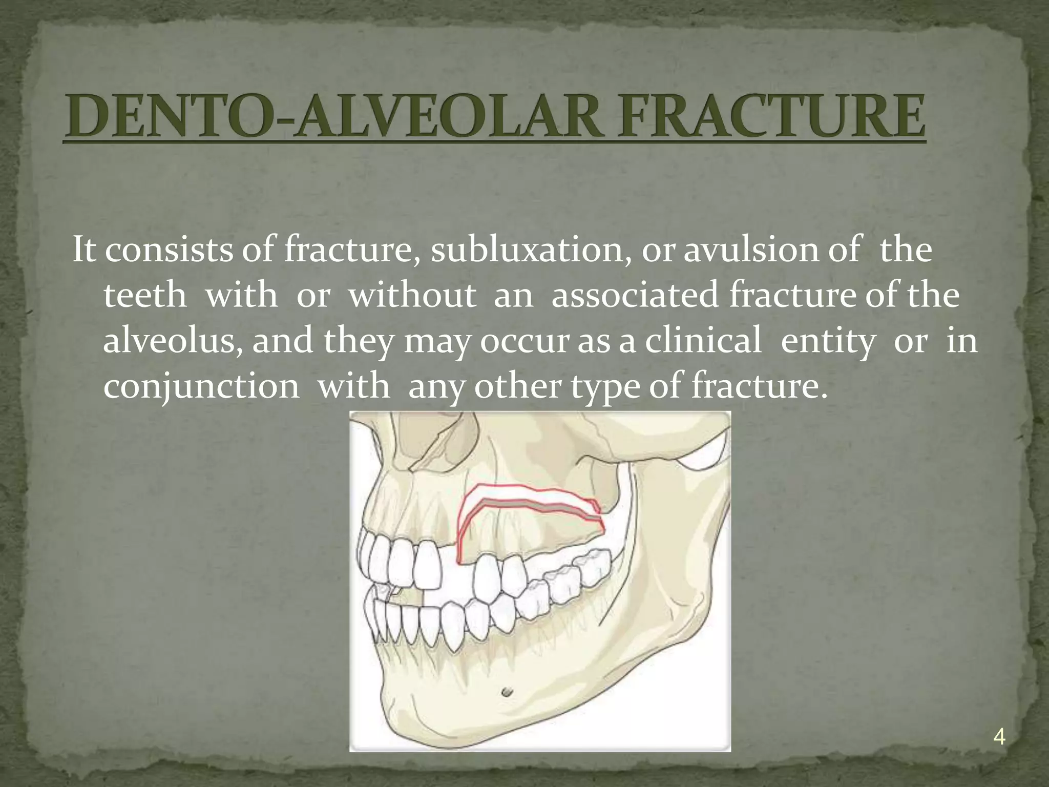 Midfacial fractures - oral surgery b.d.s | PPTX