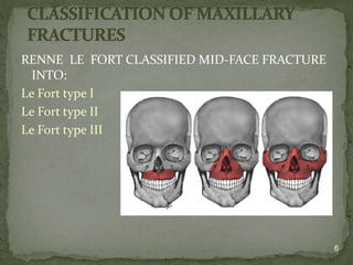 Midfacial fractures - oral surgery b.d.s | PPTX