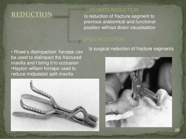 Midfacial fractures - oral surgery b.d.s