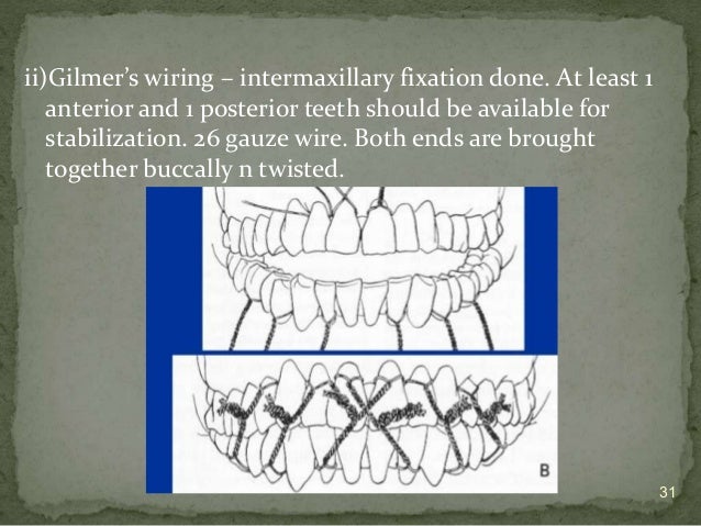 Midfacial fractures - oral surgery b.d.s