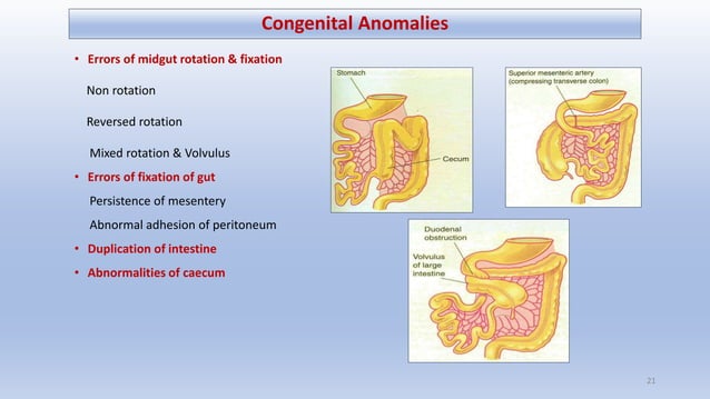 Development of Midgut & Hindgut | PPTX | Digestive Disorders | Diseases ...