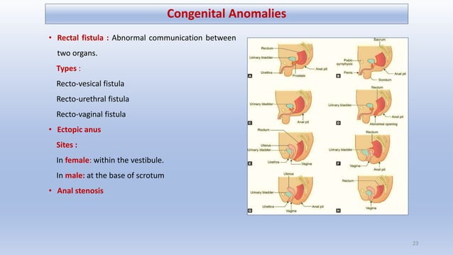 Development of Midgut & Hindgut | PPTX | Digestive Disorders | Diseases ...