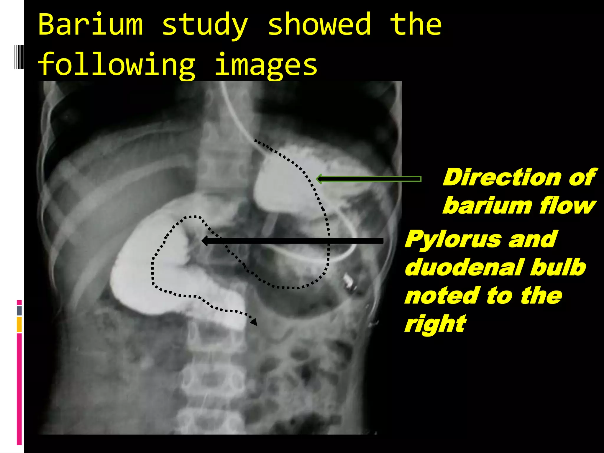 Midgut volvulus | PPTX