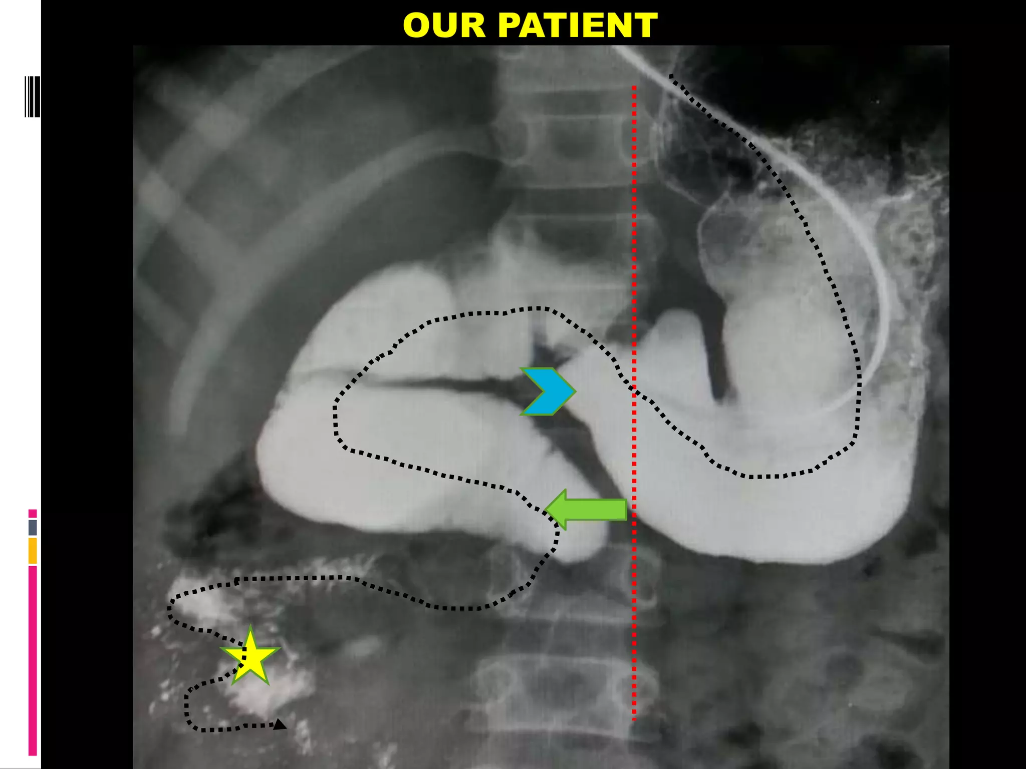 Midgut volvulus | PPTX