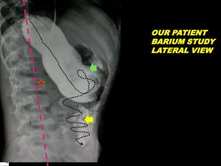 Midgut volvulus | PPTX